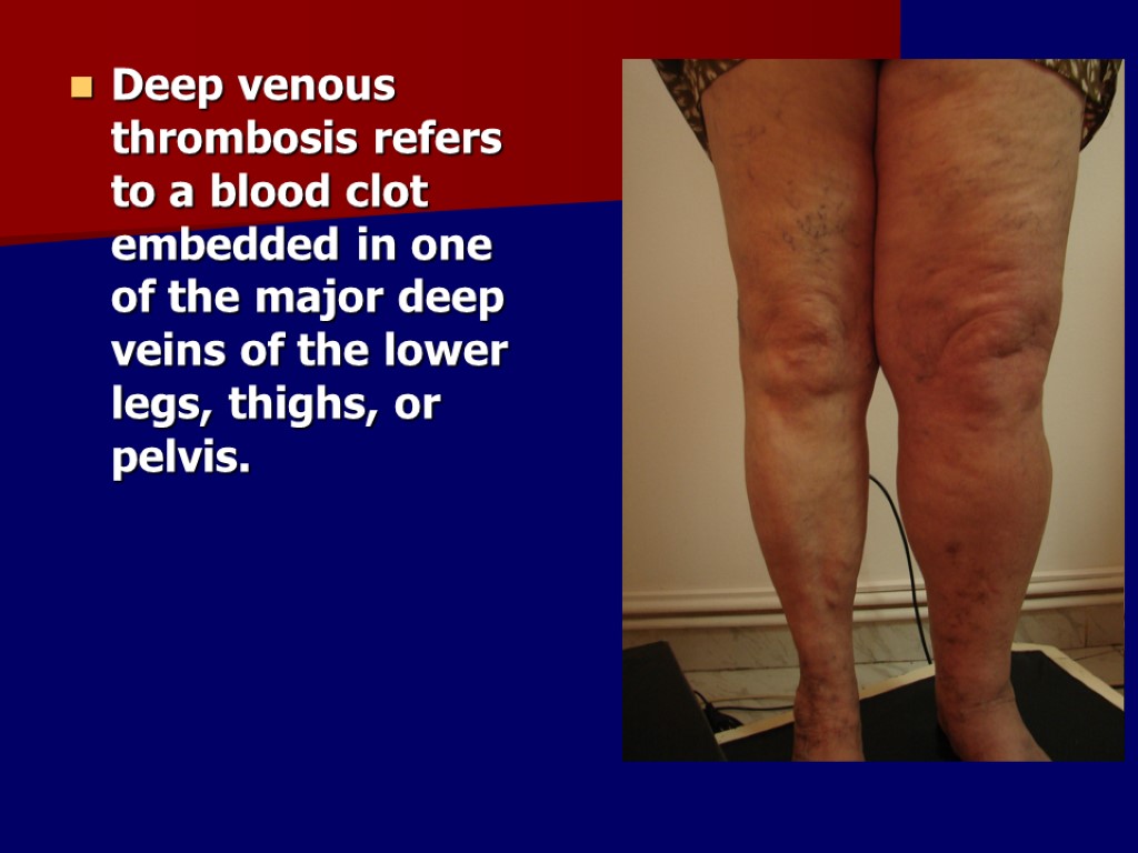 Acute purulent infections of soft tissues. A boil