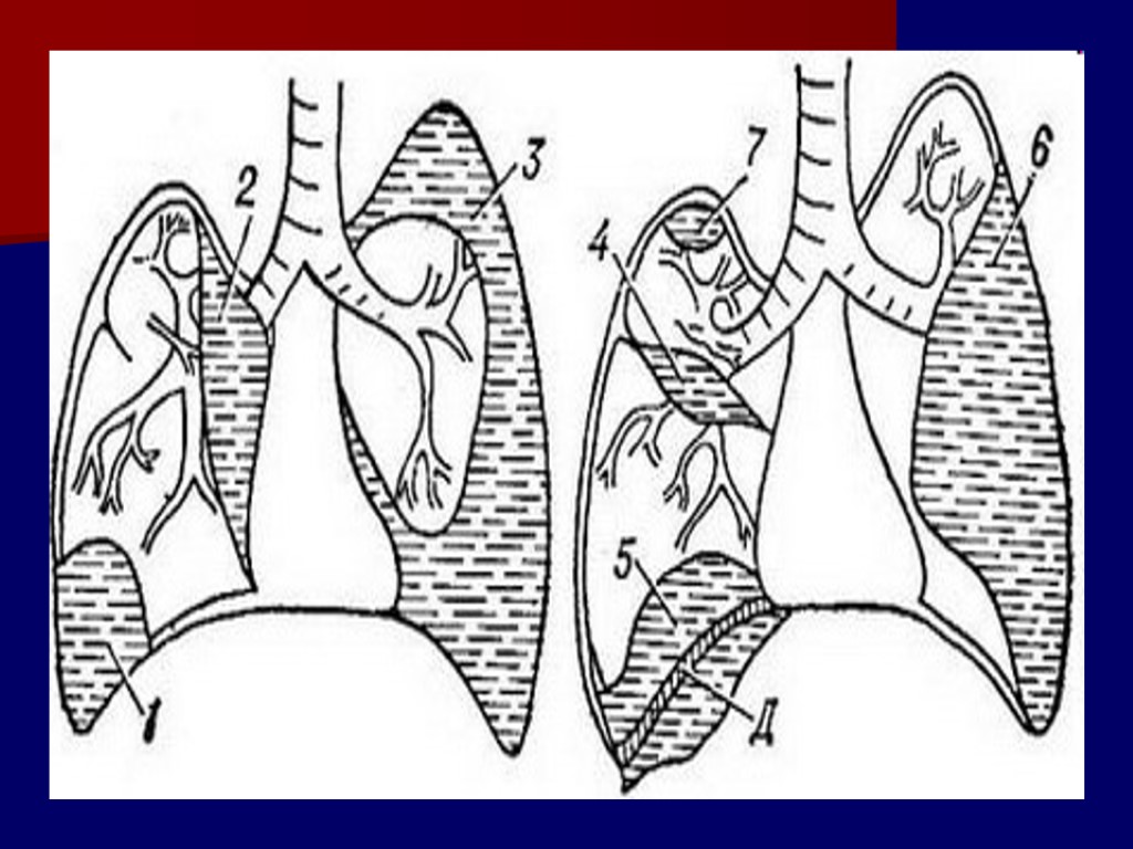 Acute purulent infections of soft tissues. A boil