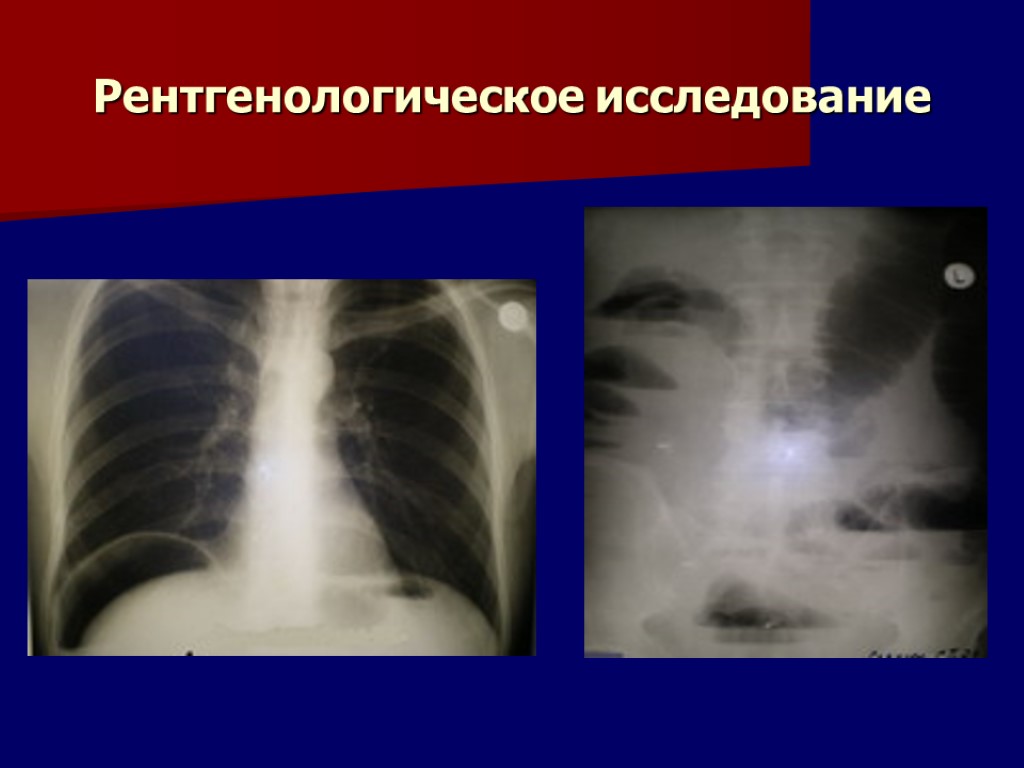 Acute purulent infections of soft tissues. A boil