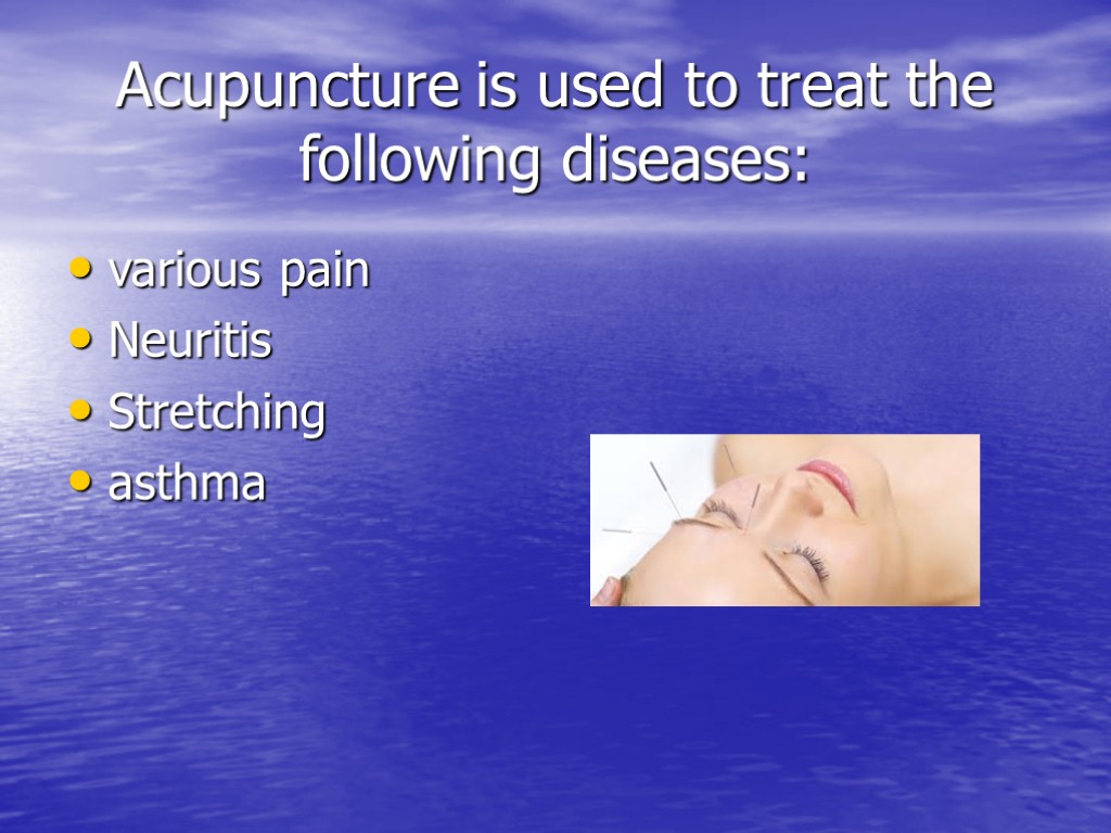 Acupuncture Performed O. Pryima. Acupuncture Acupuncture—treatment by ...