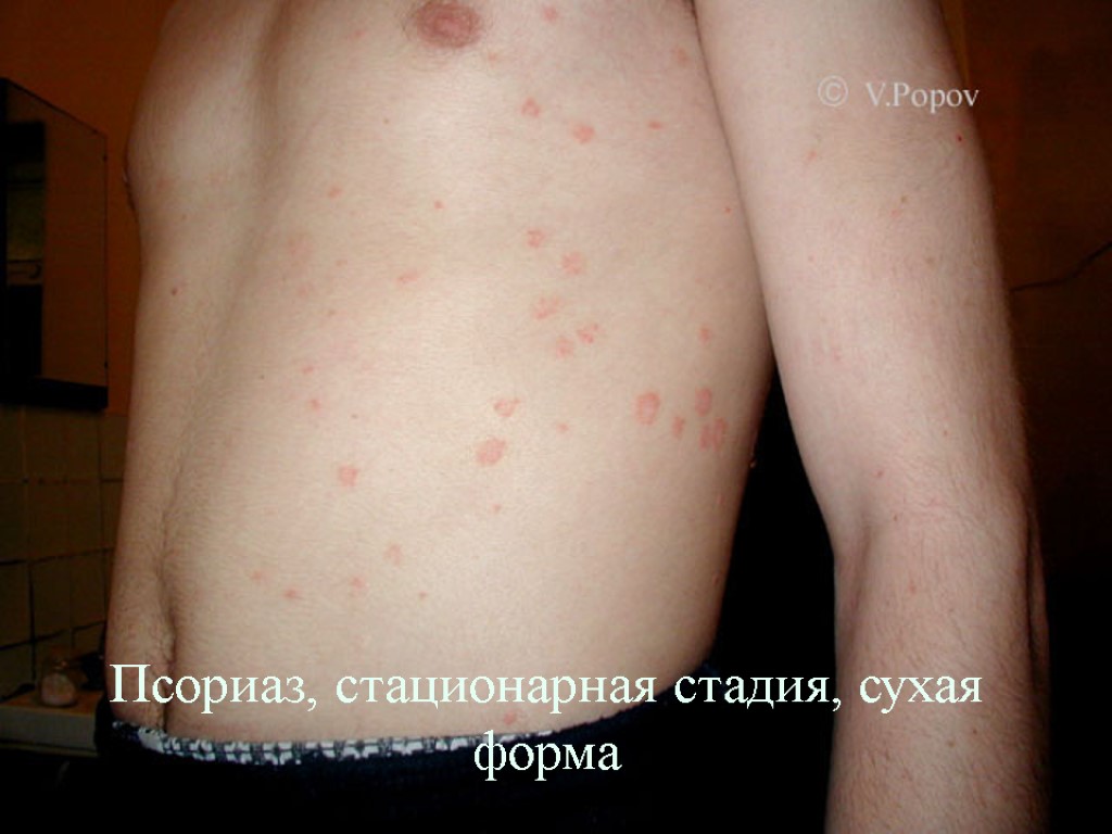 Псориаз и красный плоский лишай Составитель: к. м.