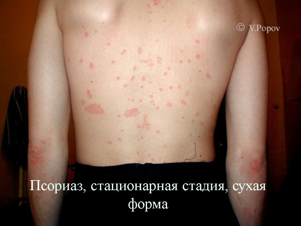 Псориаз и красный плоский лишай Составитель: к. м.