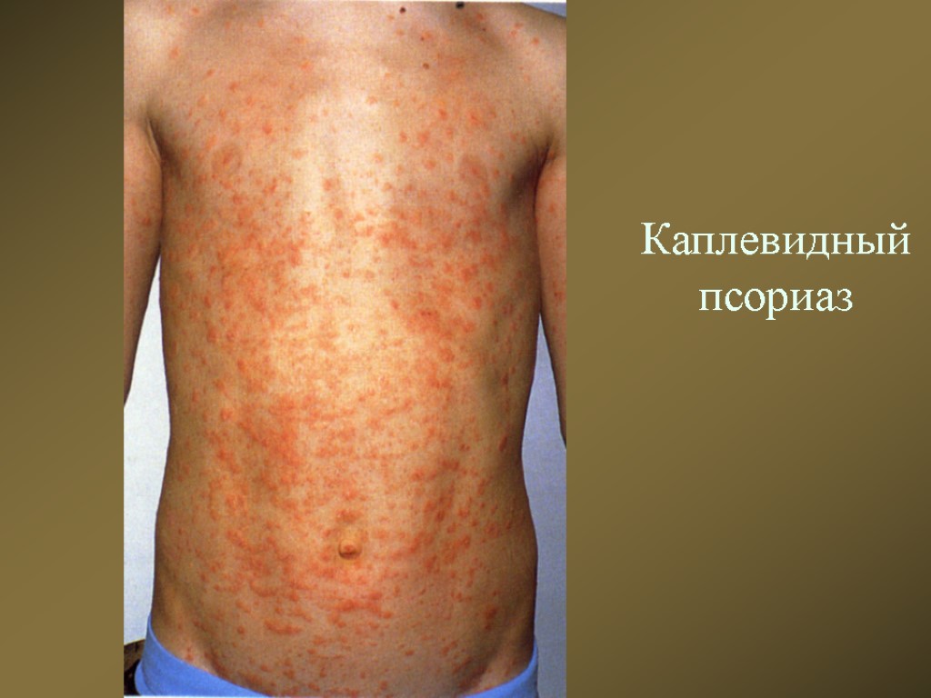 Псориаз и красный плоский лишай Составитель: к. м.