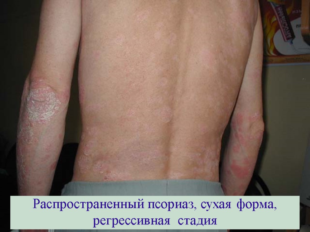 Псориаз и красный плоский лишай Составитель: к. м.