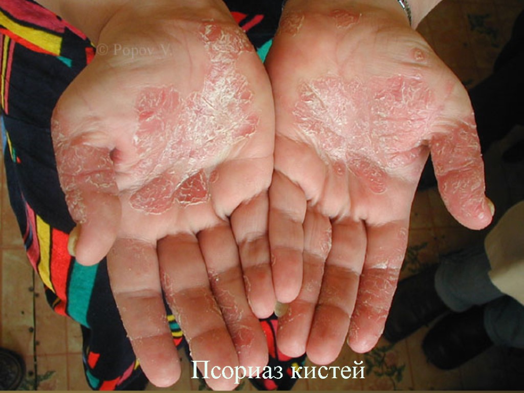 Псориаз и красный плоский лишай Составитель: к. м.