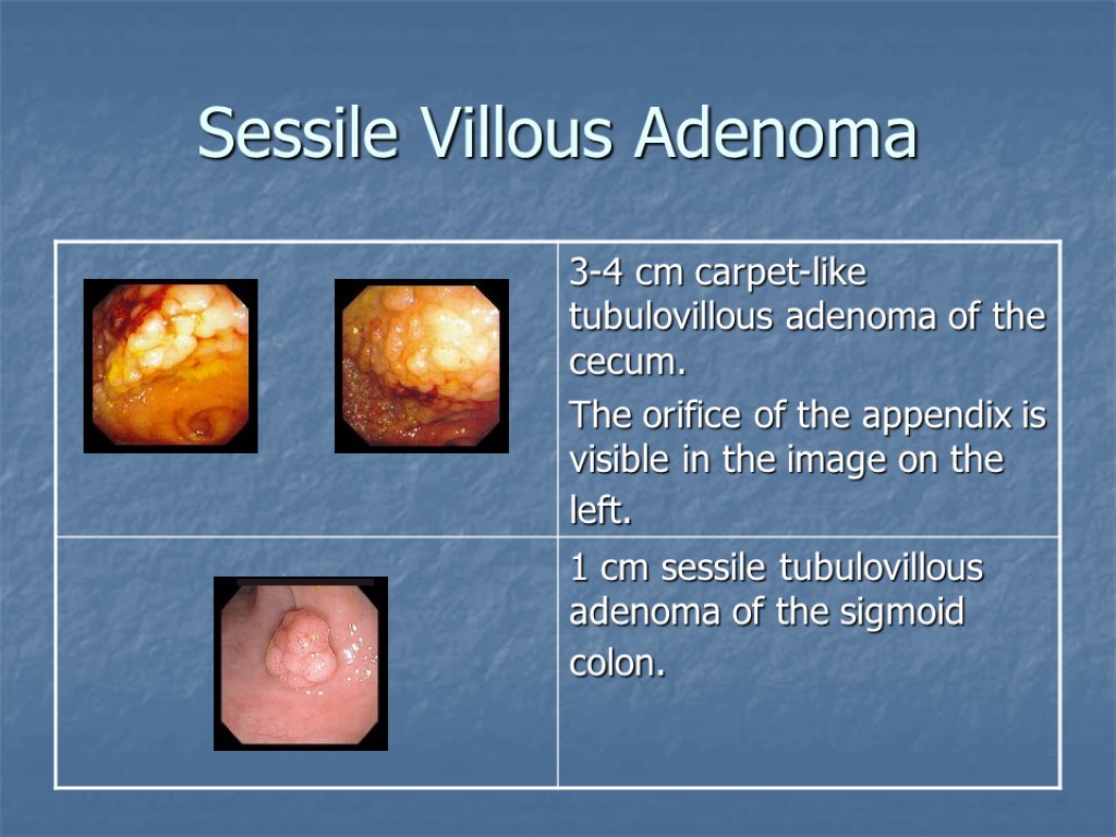 Colonic polyps Made by: Islamova Sh. Group: 646