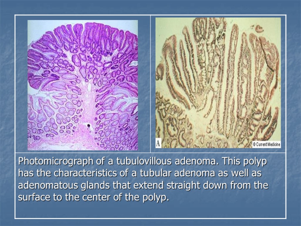Colonic polyps Made by: Islamova Sh. Group: 646