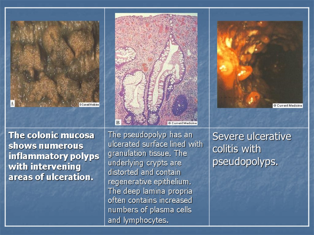 Colonic polyps Made by: Islamova Sh. Group: 646