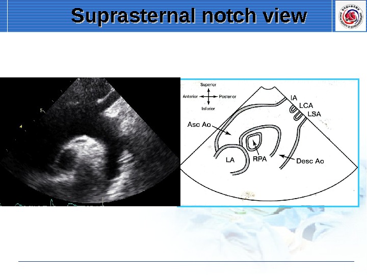 Transthoracic Echocardiography. Standard Imaging of A.