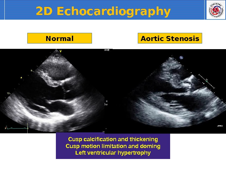 Aortic Valve Disease Normal Aortic Valve