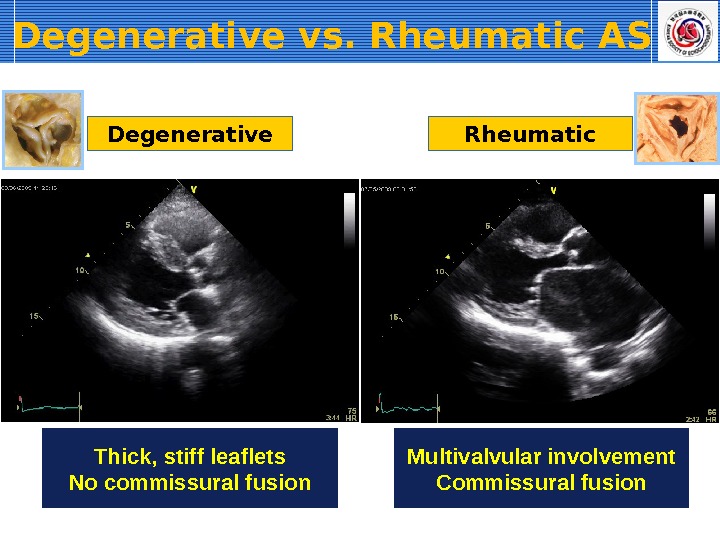 Aortic Valve Disease Normal Aortic Valve