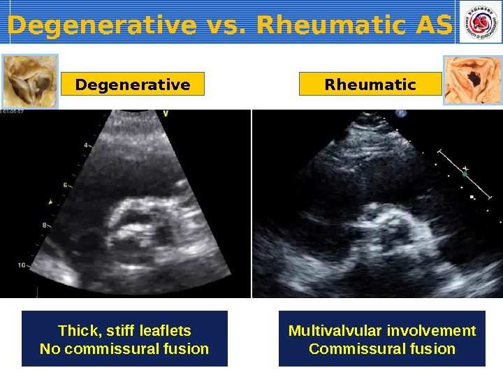 Aortic Valve Disease Normal Aortic Valve