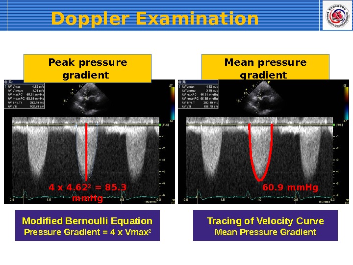 Aortic Valve Disease Normal Aortic Valve