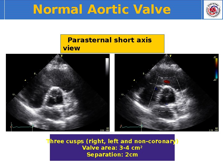 Aortic Valve Disease Normal Aortic Valve
