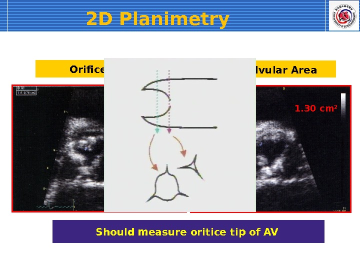 Aortic Valve Disease Normal Aortic Valve