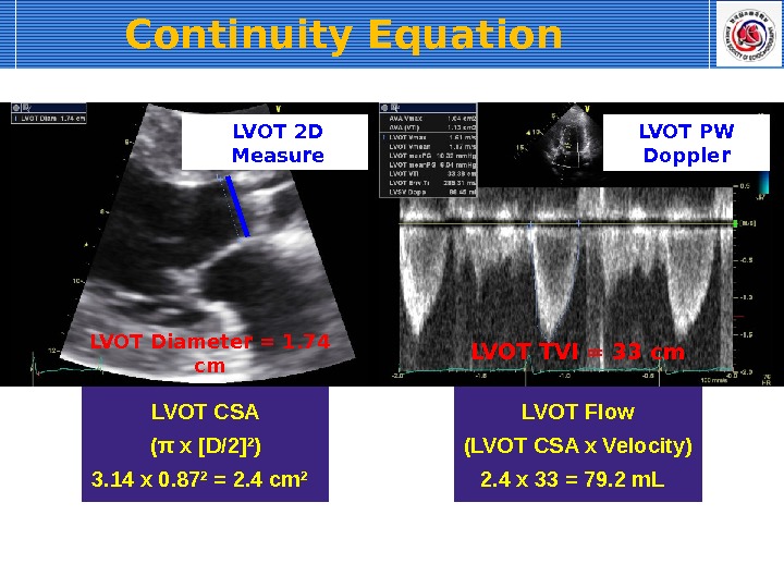 Aortic Valve Disease Normal Aortic Valve