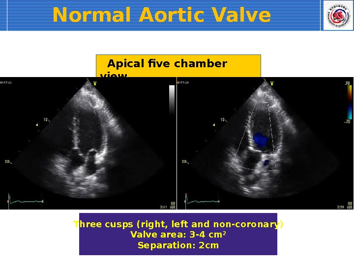 Aortic Valve Disease Normal Aortic Valve