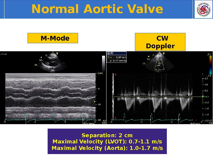 Aortic Valve Disease Normal Aortic Valve