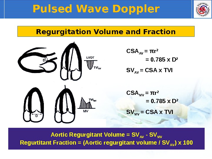 Aortic Valve Disease Normal Aortic Valve