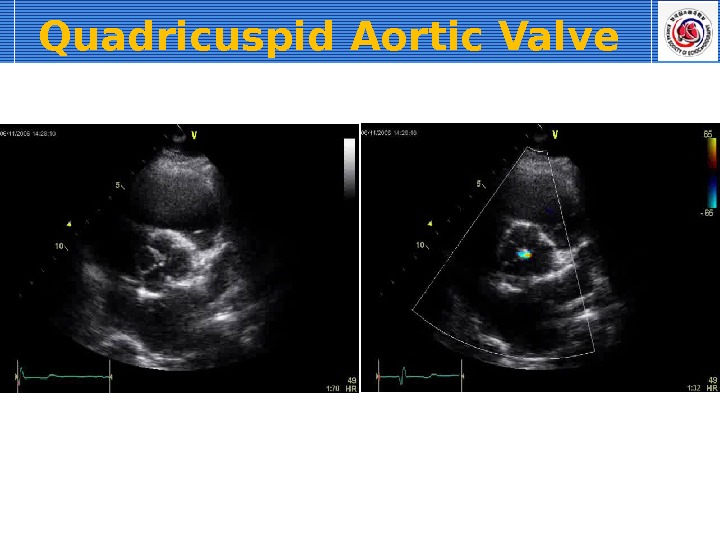 Aortic Valve Disease Normal Aortic Valve