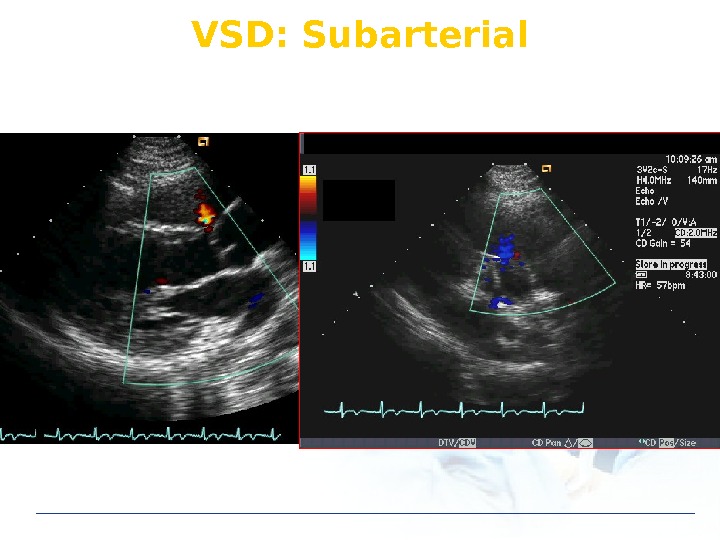 Congenital Heart Disease Adult CHD is not