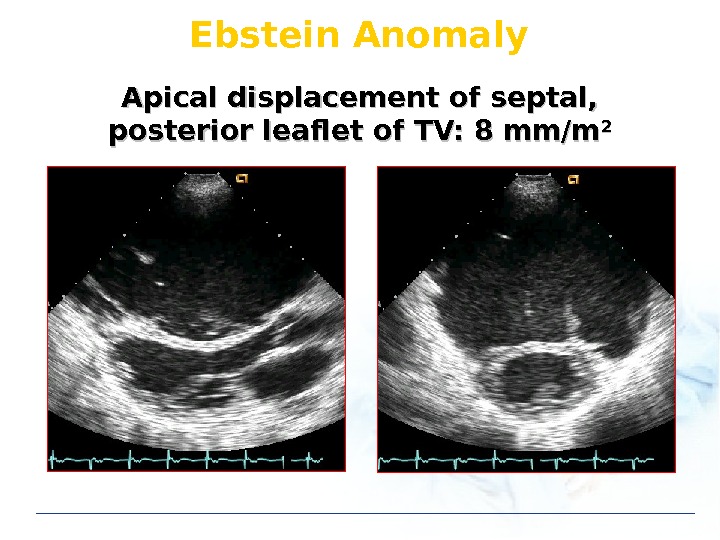 Congenital Heart Disease Adult CHD is not