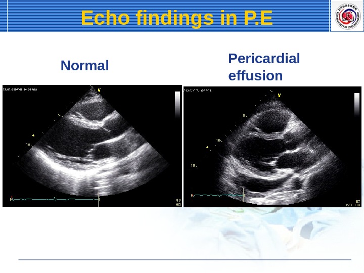 Pericardial disease Pericardium • Visceral