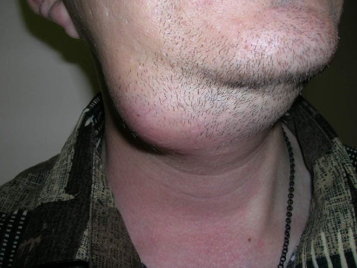 Презентация Абсцессы packed