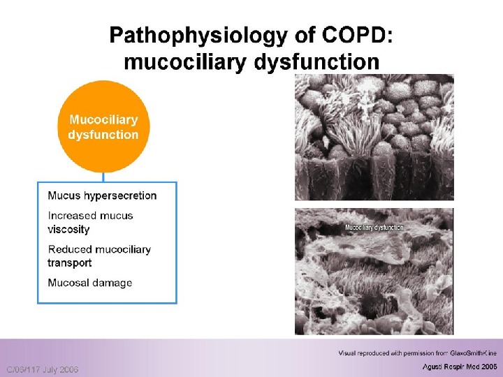 Chronic Obstructive Pulmonary Disease (( COPD