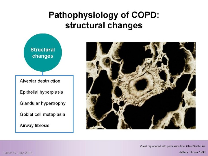 Chronic Obstructive Pulmonary Disease (( COPD