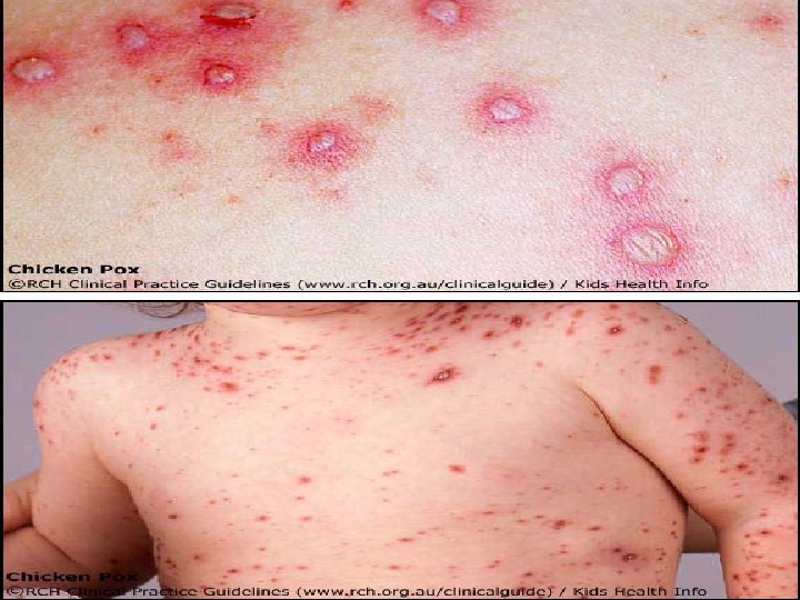 Common Pediatrics Infectious Diseases Dr. Owis khater