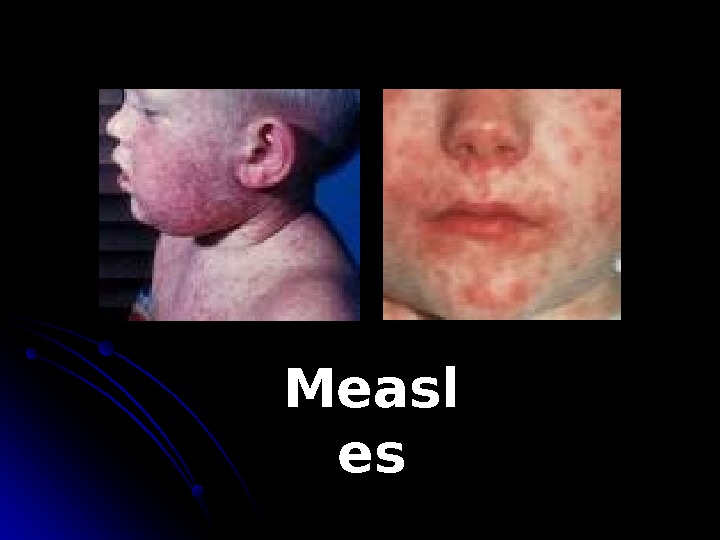 Common Pediatrics Infectious Diseases Dr. Owis khater