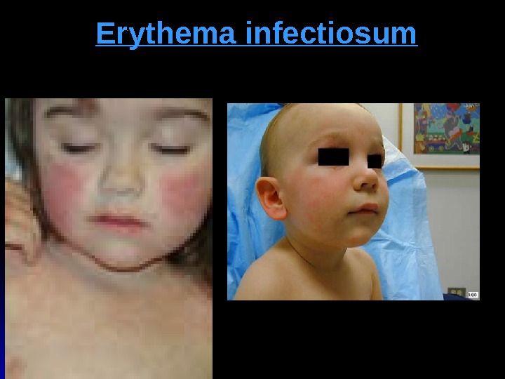 Common Pediatrics Infectious Diseases Dr. Owis khater