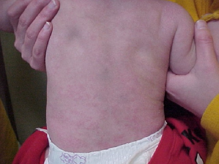 Common Pediatrics Infectious Diseases Dr. Owis khater