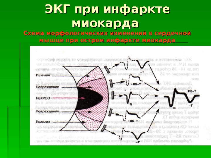 Презентация ekg pri infarkte miokarda