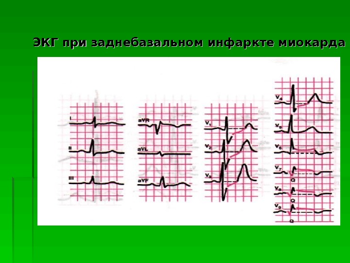 Презентация ekg pri infarkte miokarda