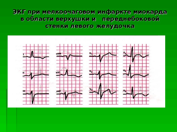 Презентация ekg pri infarkte miokarda