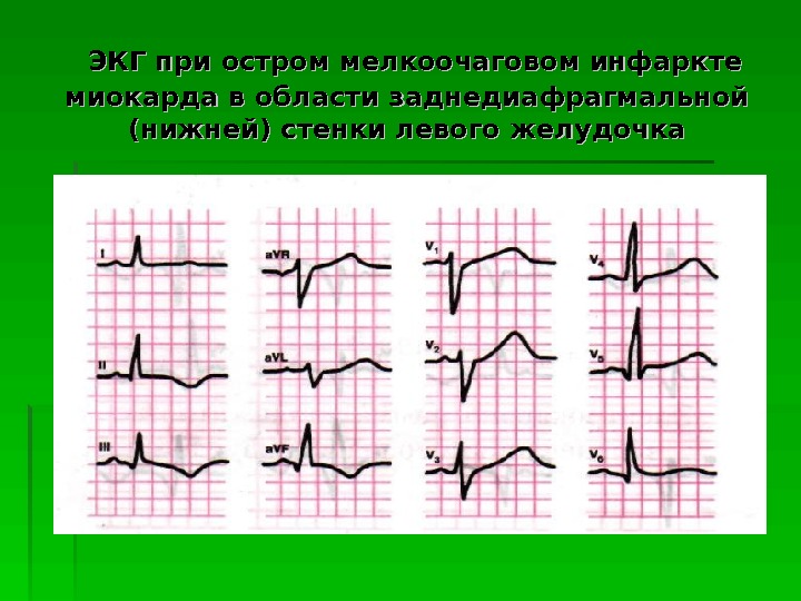 Презентация ekg pri infarkte miokarda