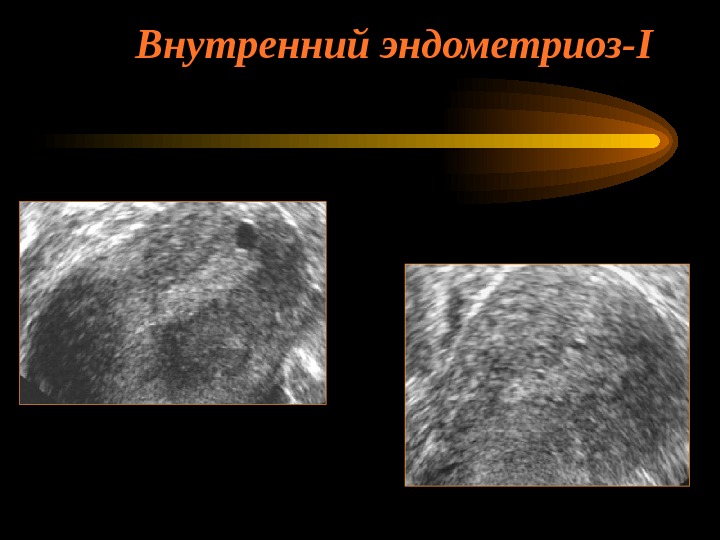 Презентация Эндометриоз для И А