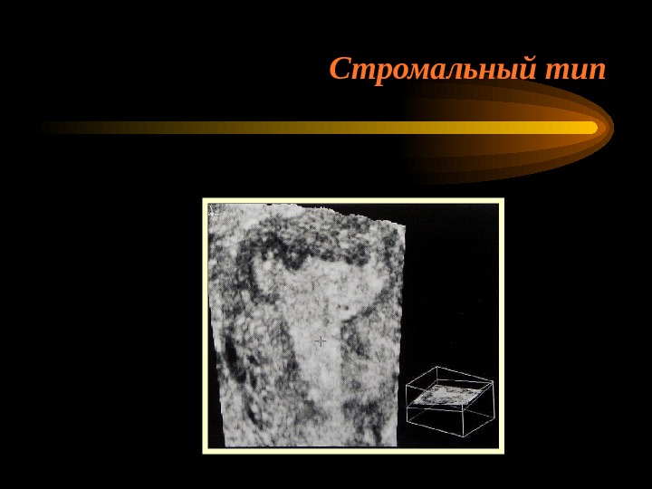 Презентация Эндометриоз для И А