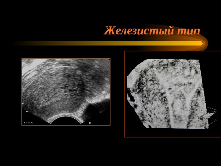 Презентация Эндометриоз для И А