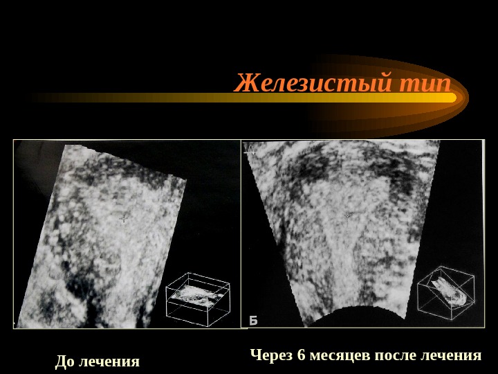 Презентация Эндометриоз для И А