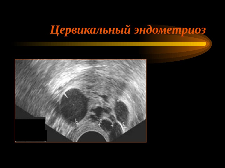 Презентация Эндометриоз для И А