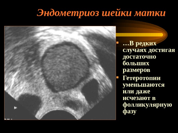 Презентация Эндометриоз для И А