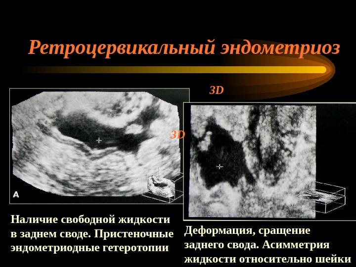 Презентация Эндометриоз для И А