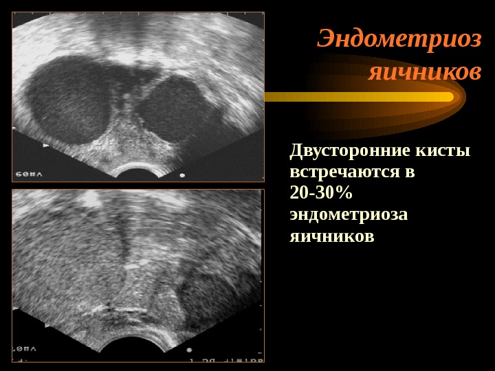 Презентация Эндометриоз для И А