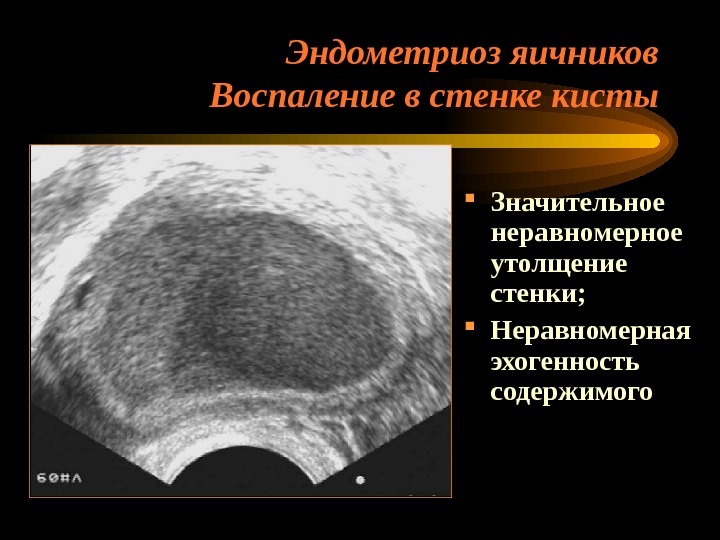 Презентация Эндометриоз для И А