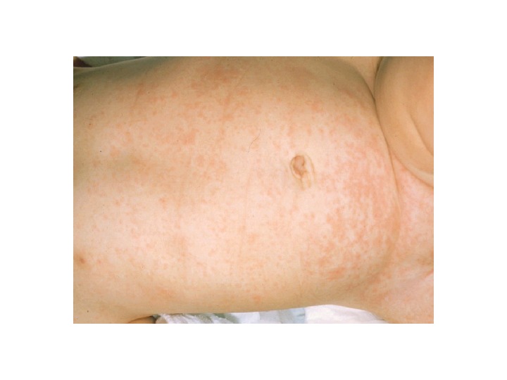 Fever and Rash Marcellina Mian Professor of Pediatrics