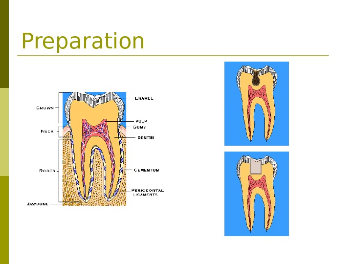 FILLING OF CAVITIES 1&5 CLASS BY BLACK PHANTOM