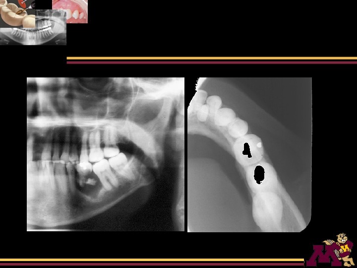 Radiographic Interpretation of Infections of Jaws Pericoronitis
